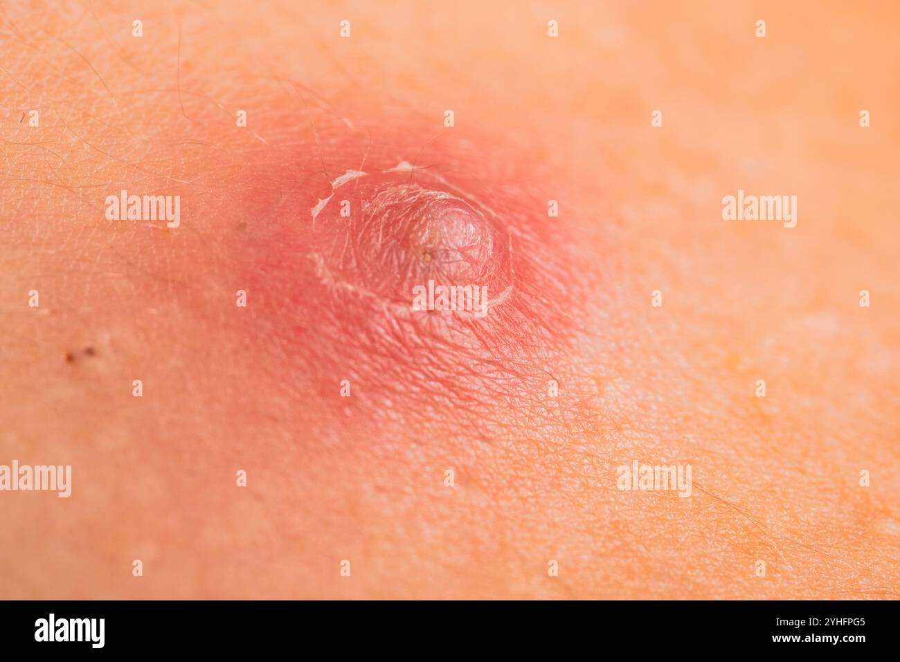 Acne and pimple. Skin care. Pimple closeup. Dermatology skincare ...