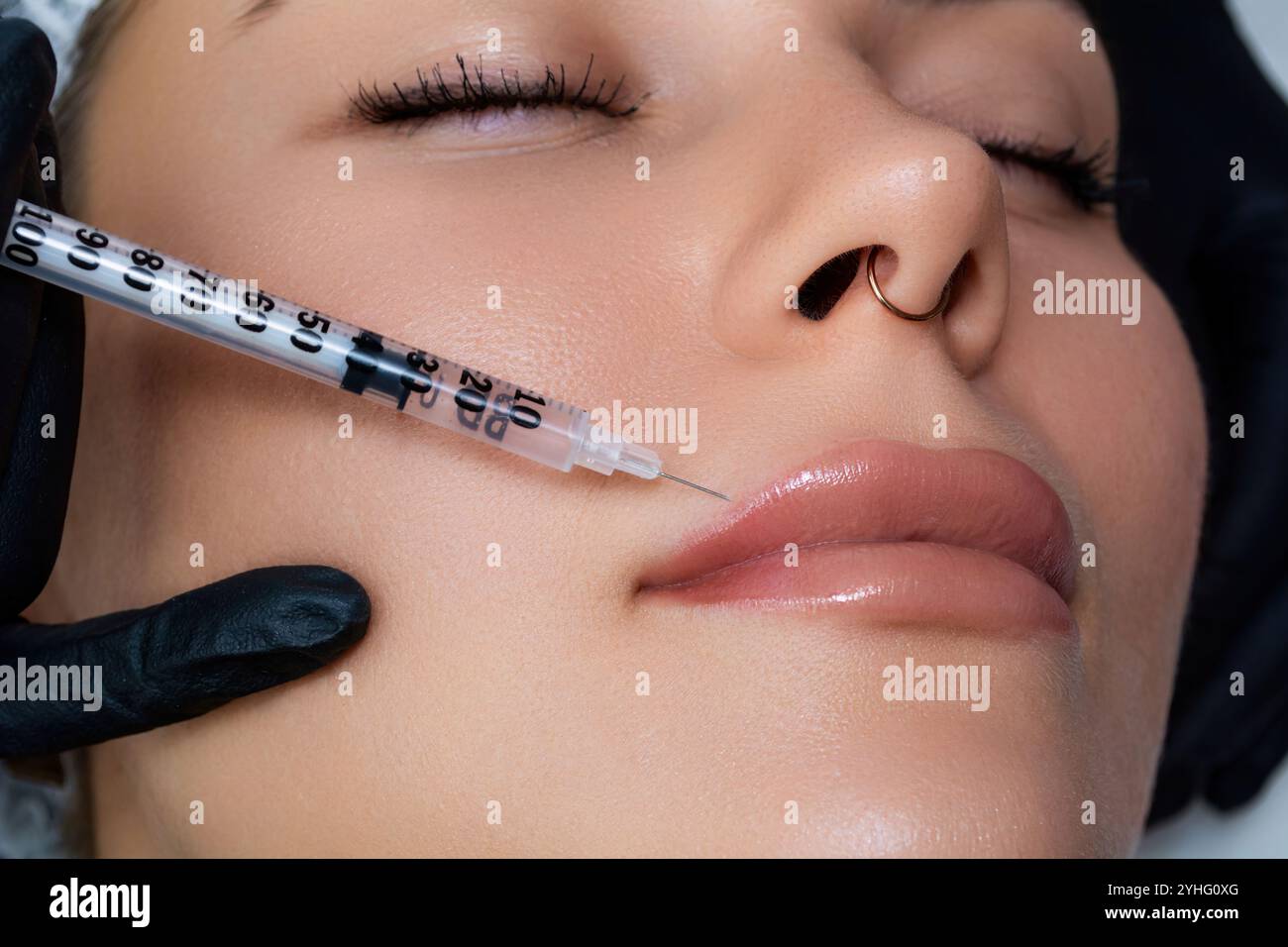 A beautician performs a lip augmentation procedure with hyaluronic acid ...