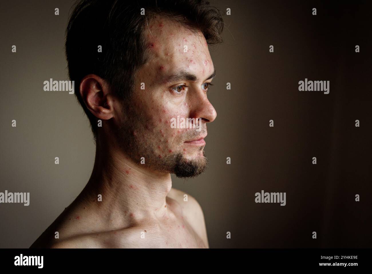 Man's body is covered with a spotted, red pimple and blister rash ...