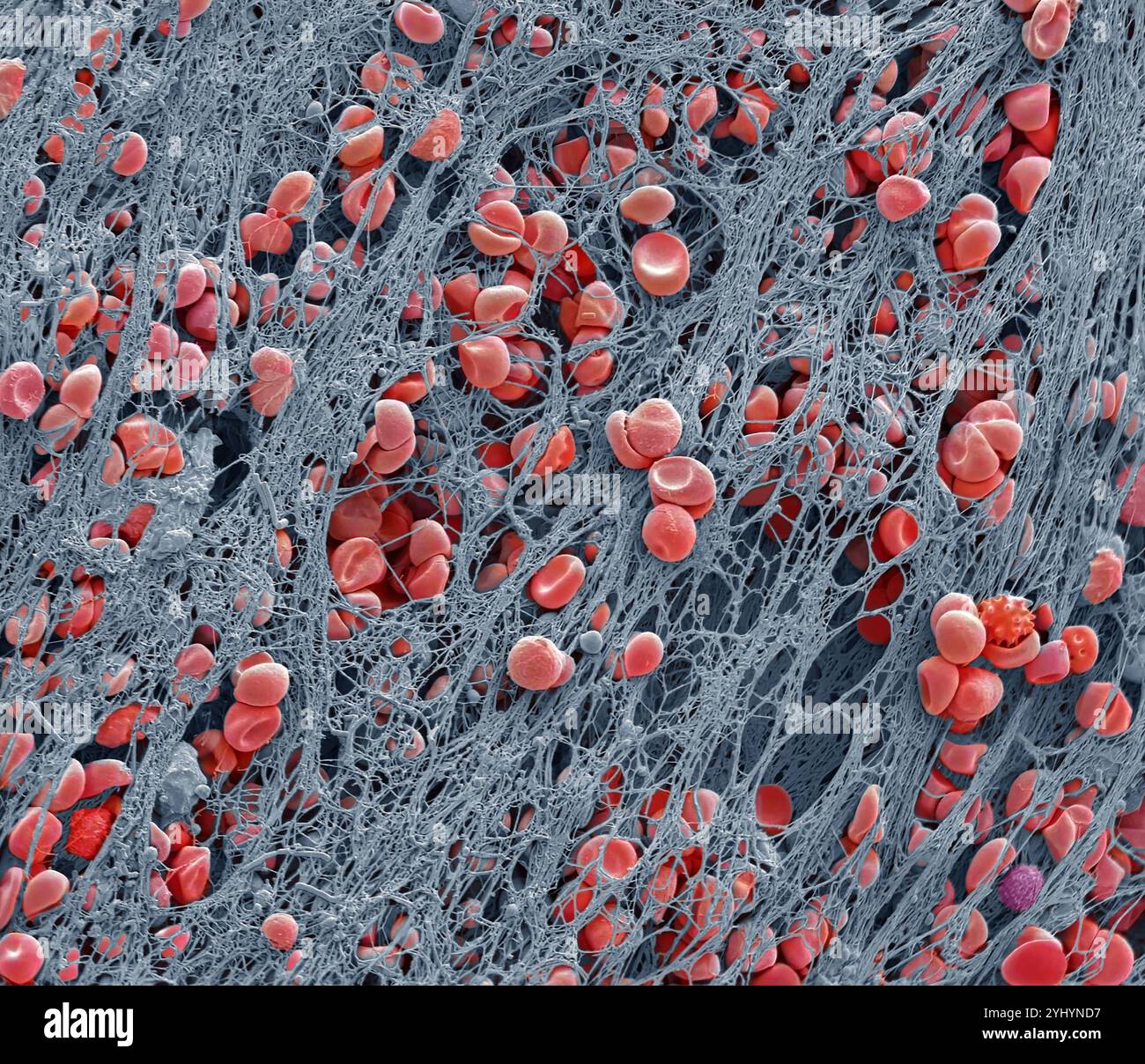 Blood clot. Coloured scanning electron micrograph (SEM) of red blood ...