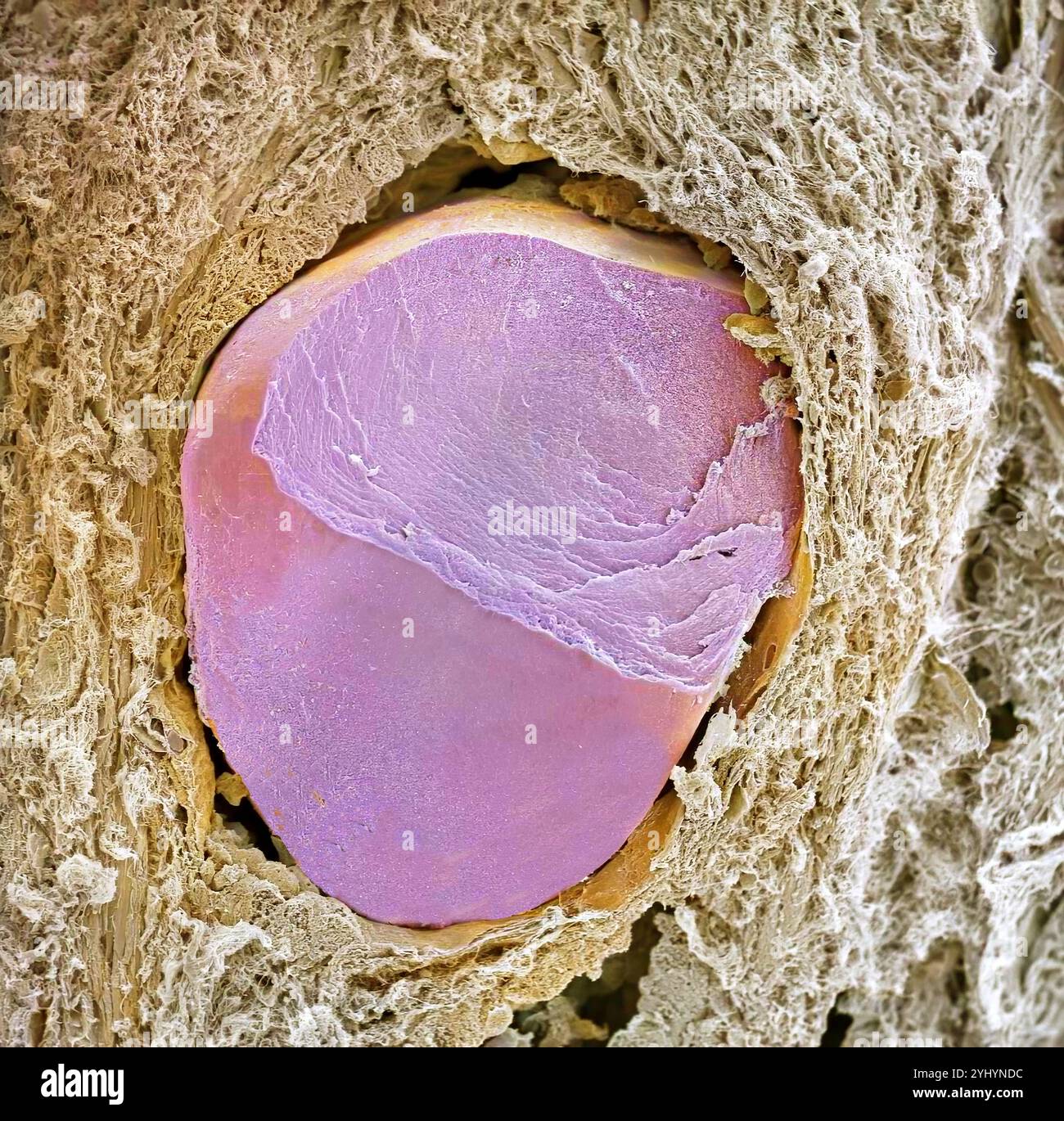 Corpora Amylacea Coloured Scanning Electron Micrograph Sem Corpora Amylacea Are Prostatic