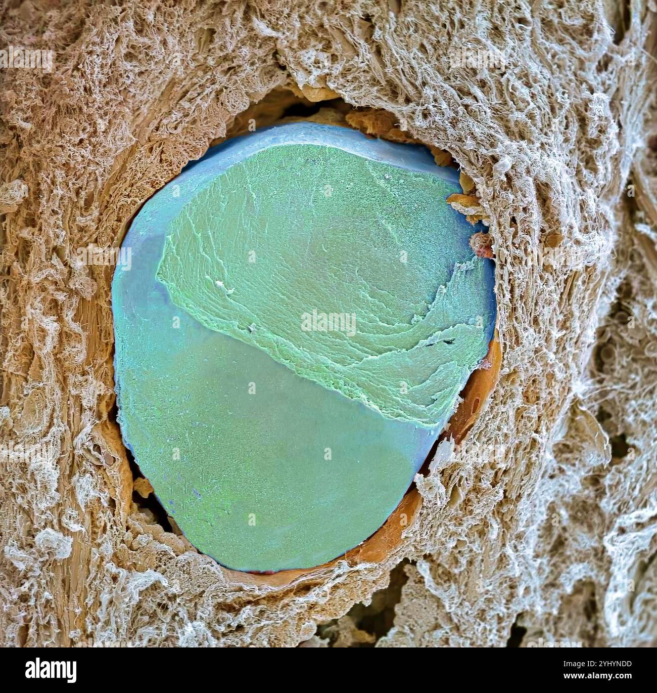 Corpora amylacea. Coloured scanning electron micrograph (SEM). Corpora ...