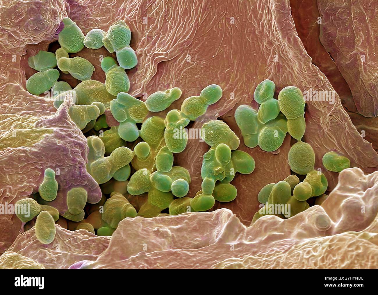 Acne bacteria. Coloured scanning electron micrograph (SEM) of a skin ...