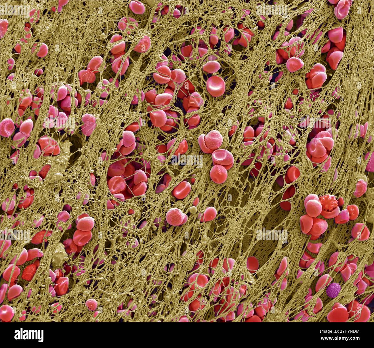 Blood clot. Coloured scanning electron micrograph (SEM) of red blood ...