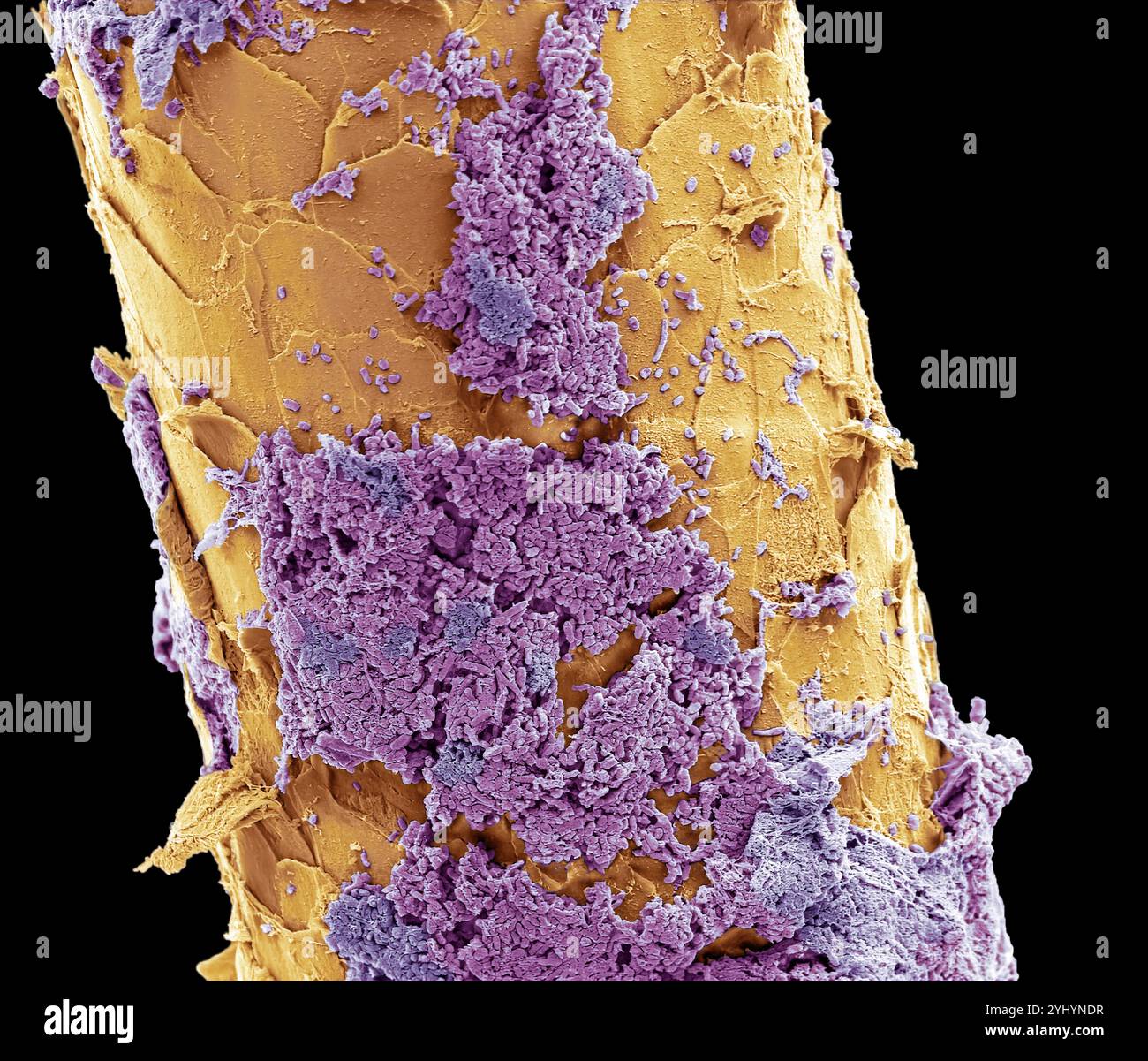 Ingrowing hair. Coloured scanning electron micrograph (SEM) of an ...