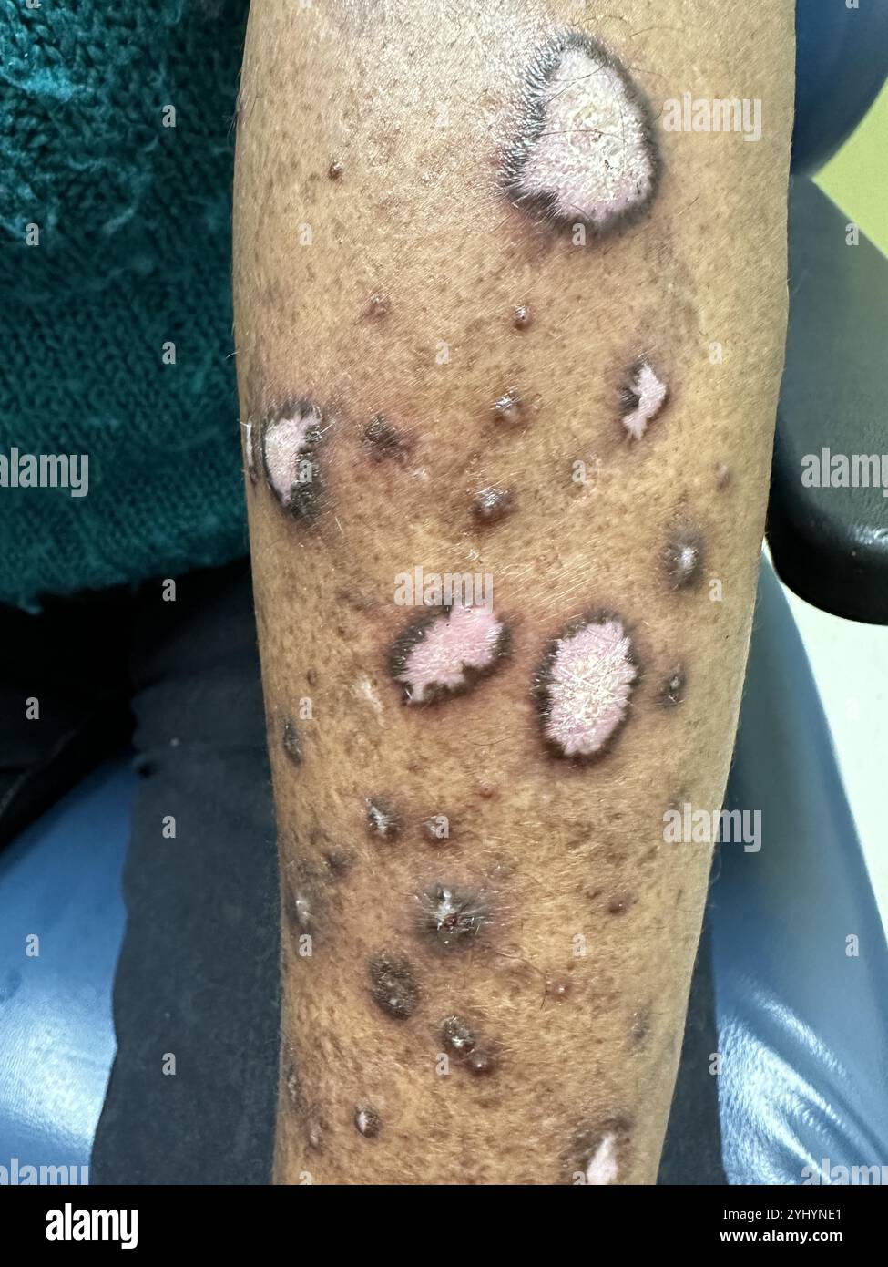 Lesions on the arm of a female African-American patient with ...