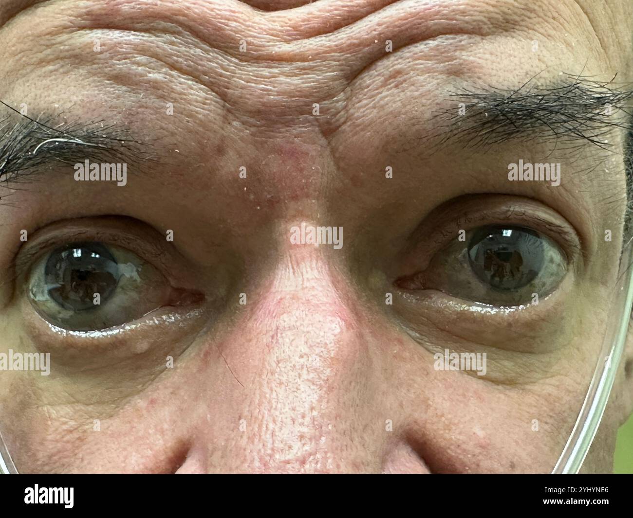 Editorial use only Minocycline hyperpigmentation affecting the whites ...