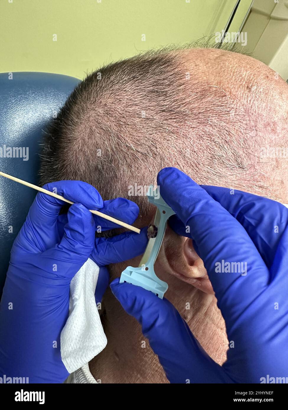 Shave biopsy of squamous cell carcinoma Stock Photo - Alamy