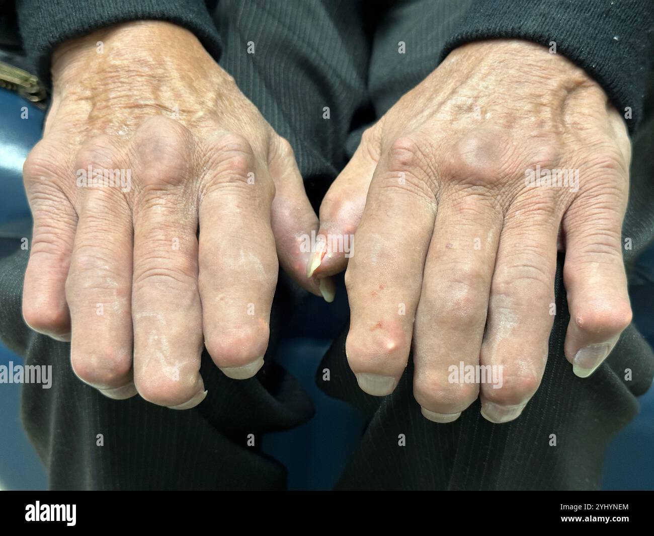 Not to be used for advertising or in a defamatory context Calcinosis ...