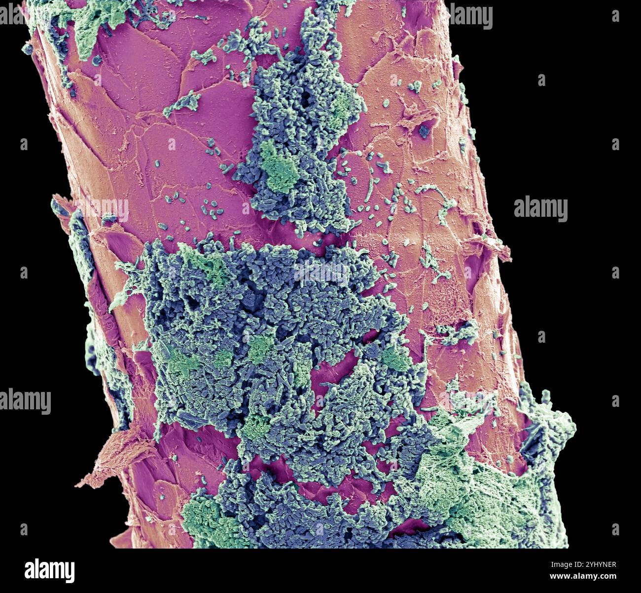 Ingrowing hair. Coloured scanning electron micrograph (SEM) of an ...