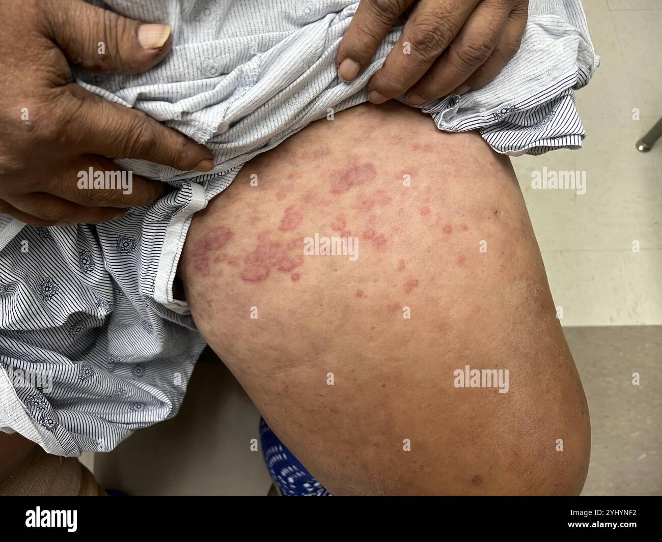 Rheumatoid rash on the thigh of a patient with rheumatoid arthritis ...