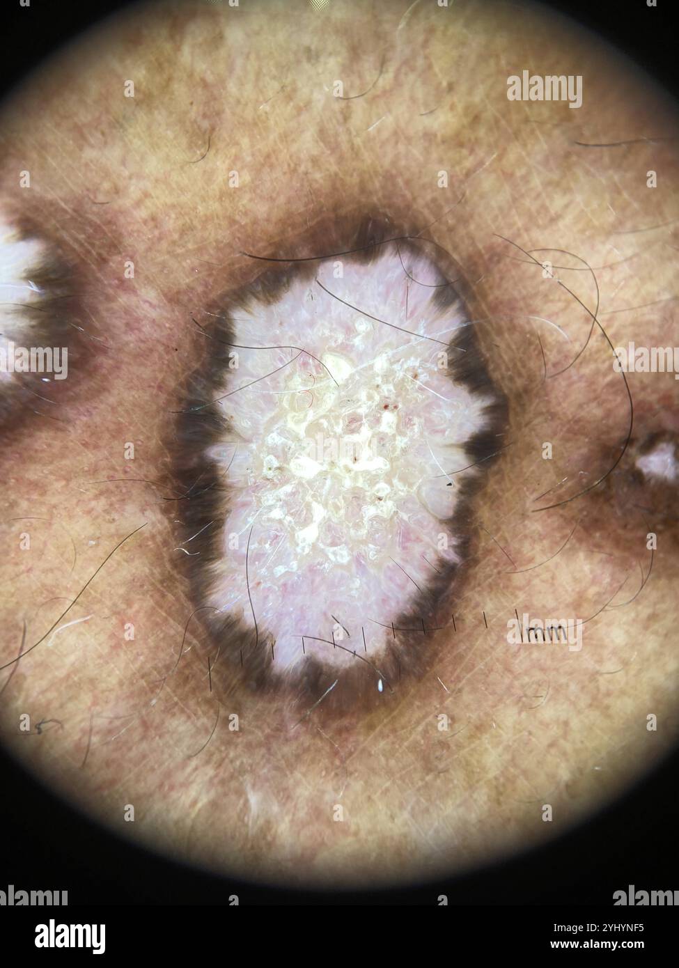 Dermatoscope image of lesions on the skin of a female African-American ...