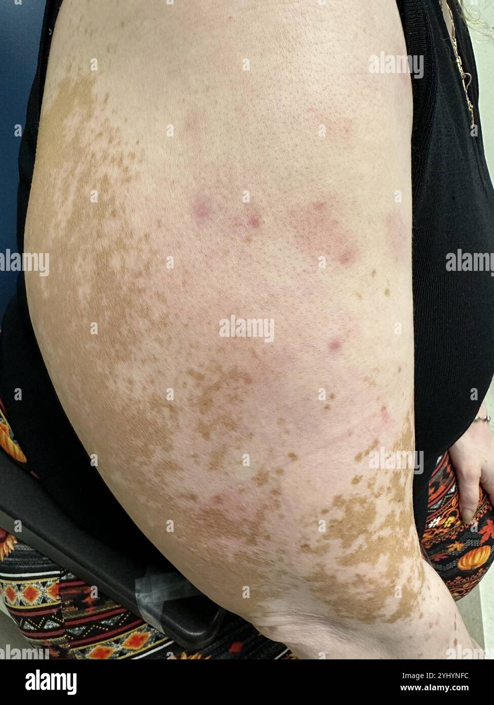 Vitiligo on a patient's arm. Vitiligo (leukoderma) is a chronic skin ...