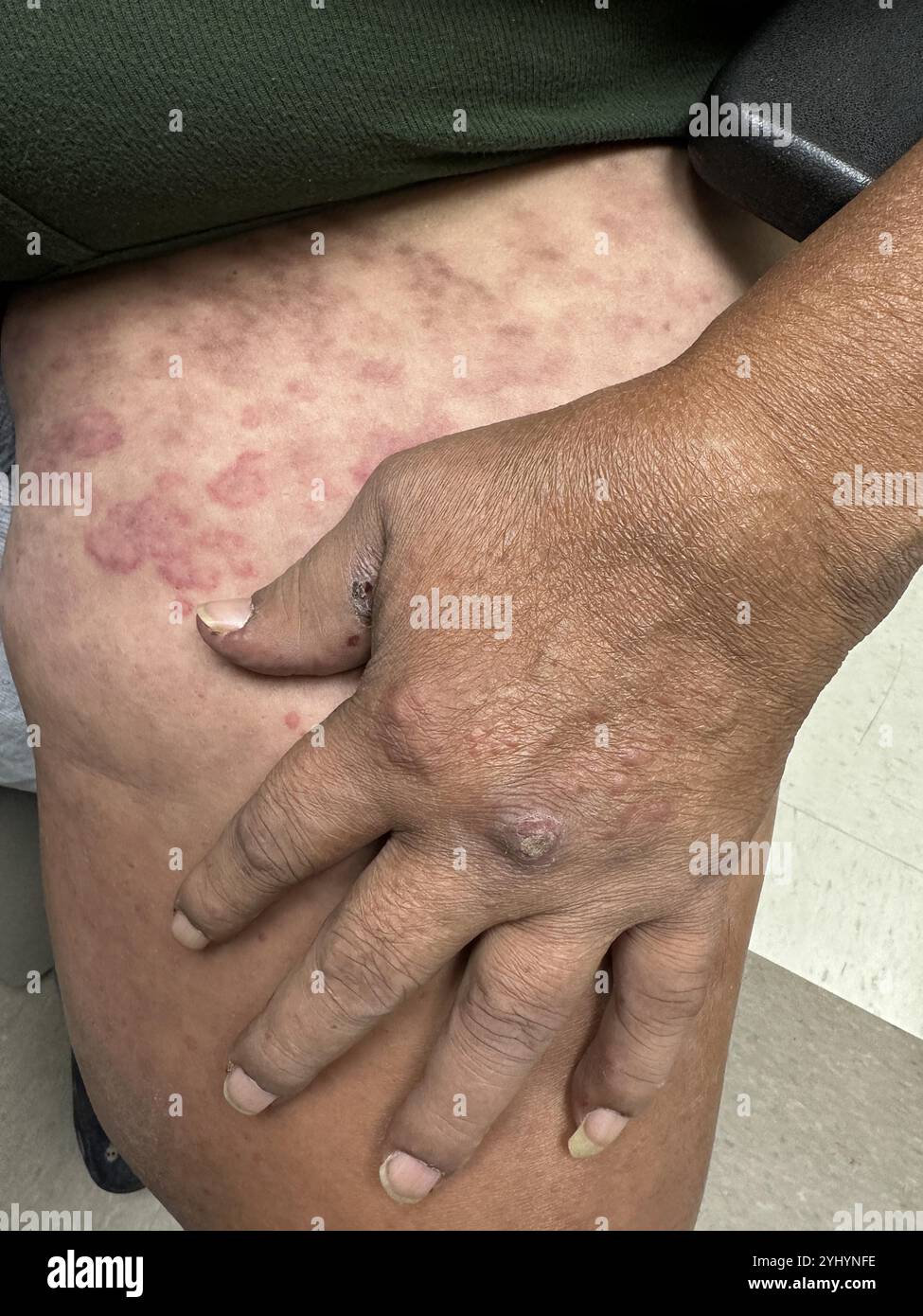 Rheumatoid nodules on the hand and rash on the thigh of a patient with ...