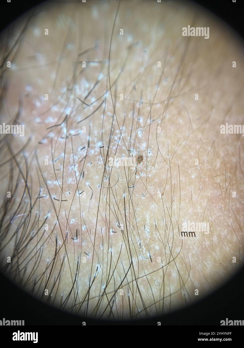 Dermatoscope image of a ringworm infection a patient's scalp. Ringworm ...