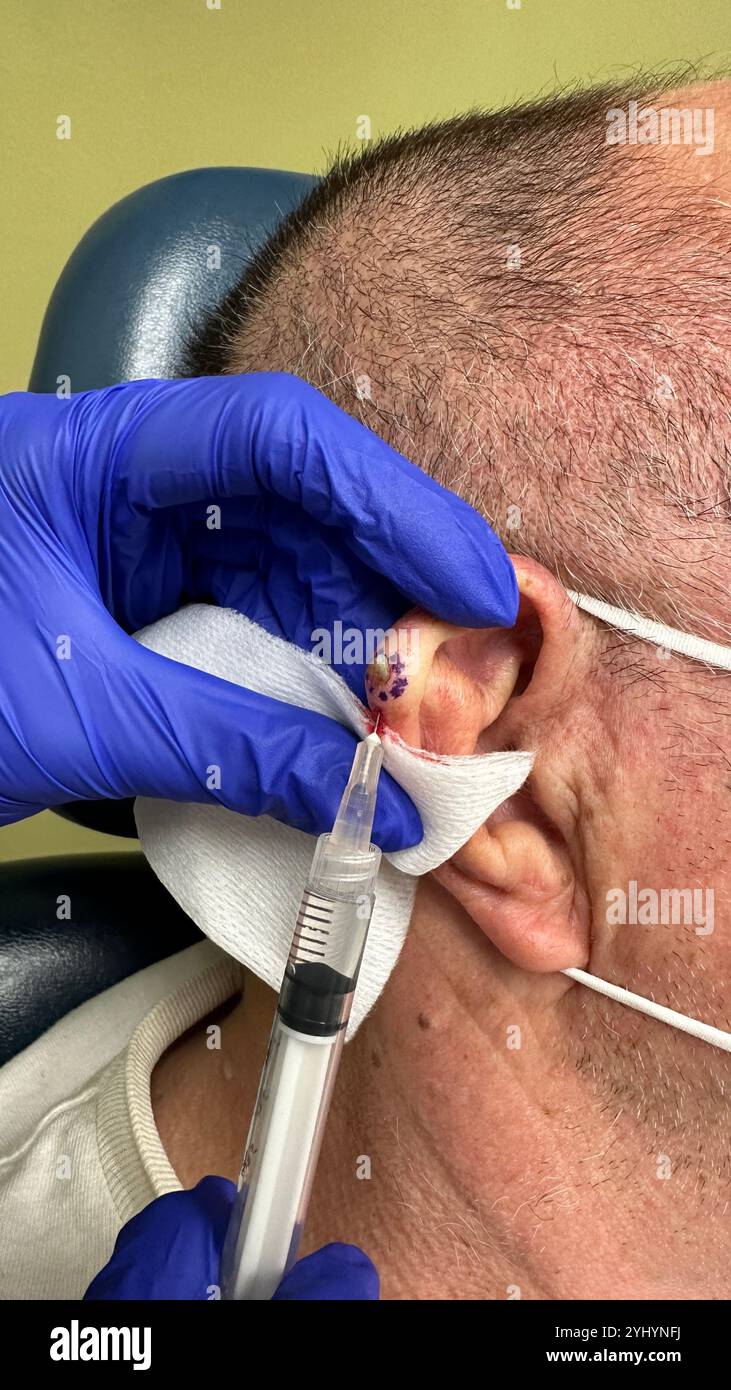 Shave biopsy of squamous cell carcinoma Stock Photo - Alamy