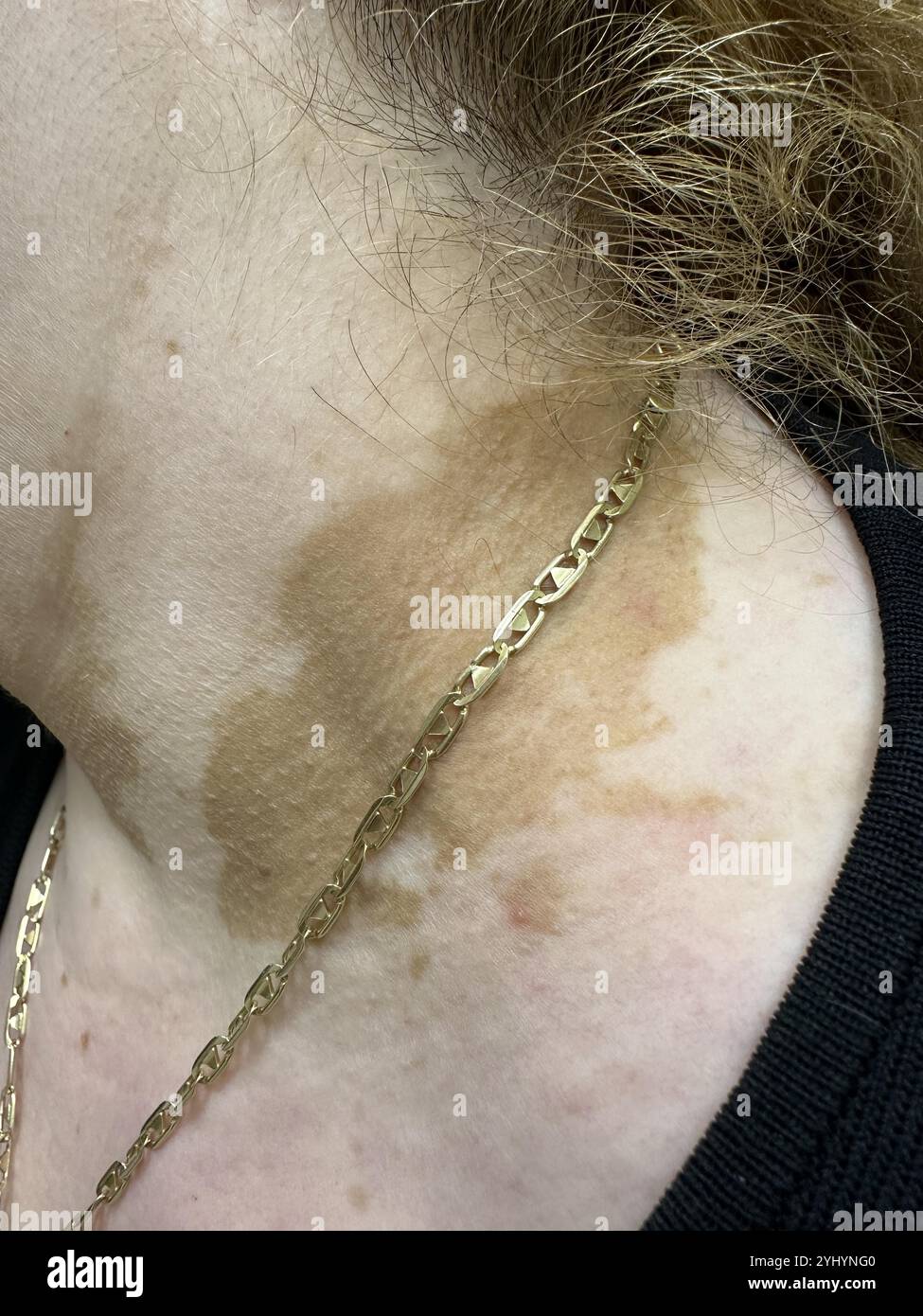 Vitiligo on a Hispanic female patient's neck. Vitiligo (leukoderma) is ...