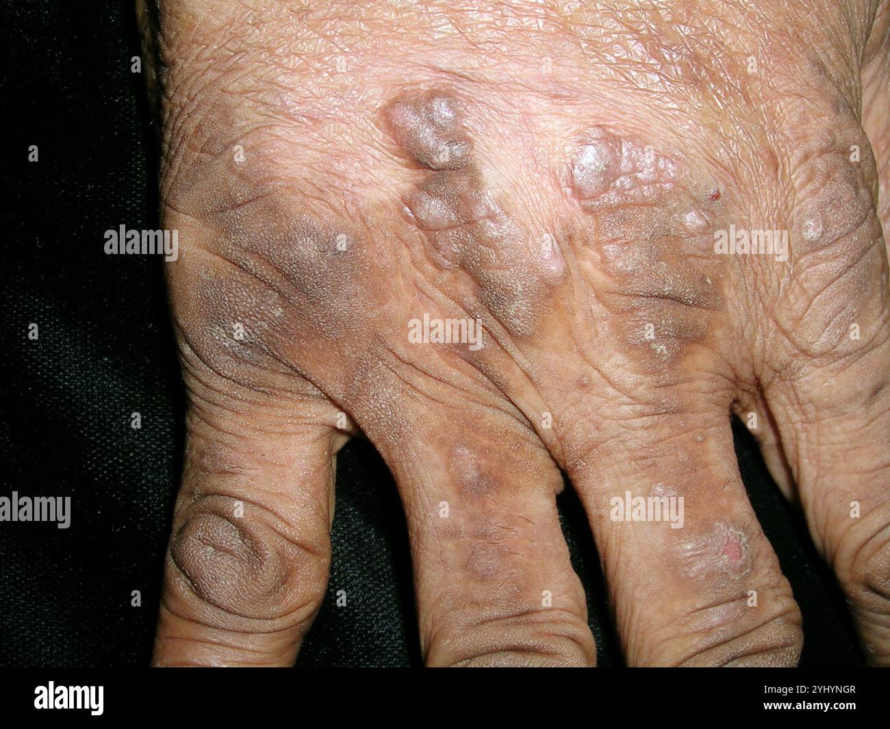 Psoriasis on an African-American male patient's hand. Psoriasis is a ...