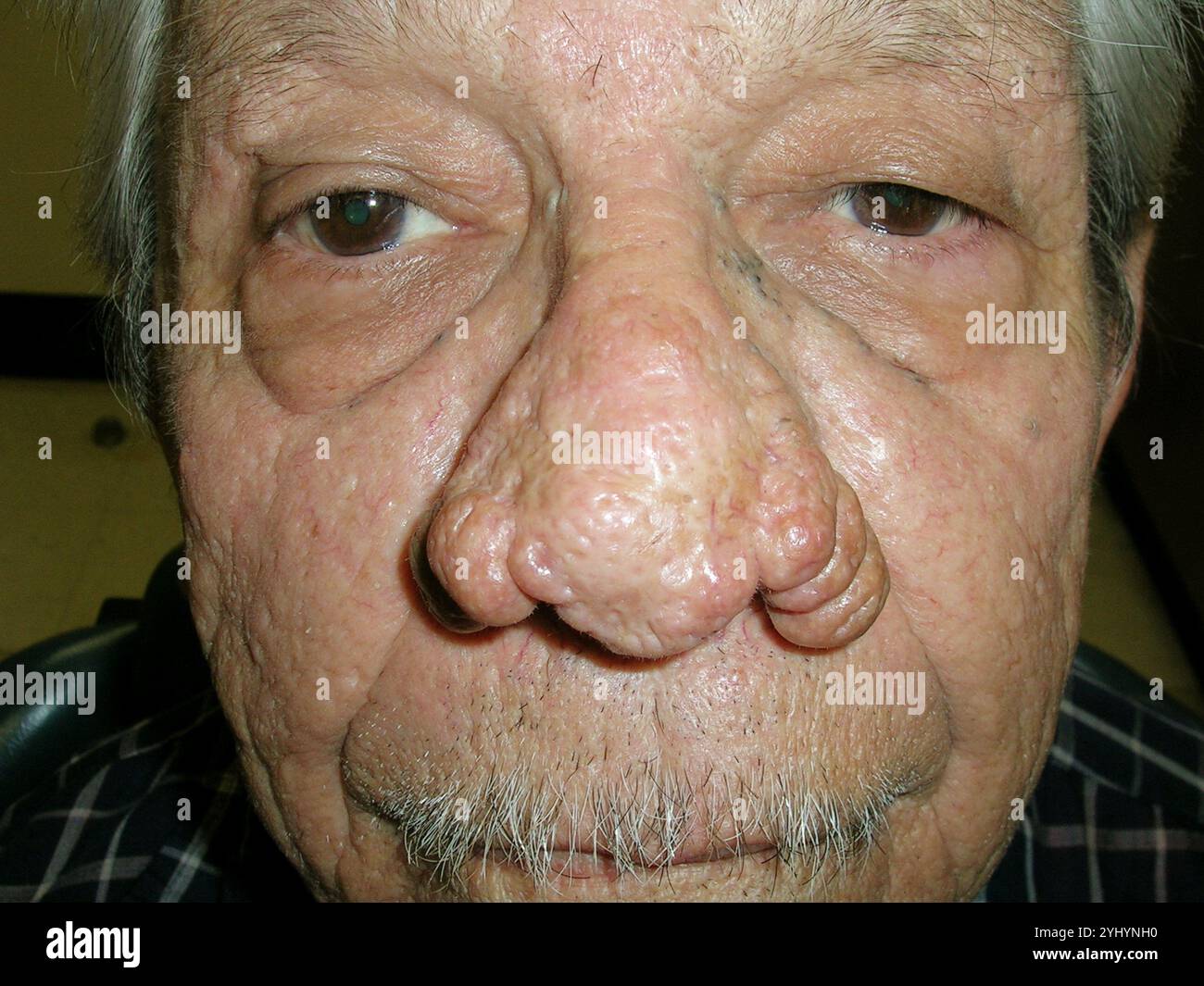 Bulbous nose of a patient with rhinophyma who has had surgery to treat ...