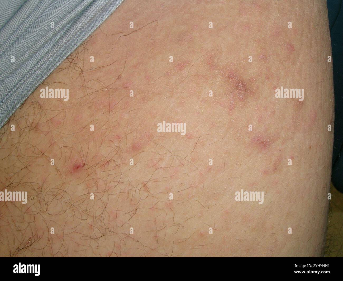 Groin of a 19 year old Hispanic male patient infected with scabies ...
