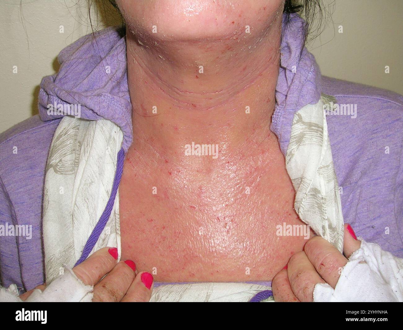 Atopic dermatitis on a female patient's chest. Atopic dermatitis, also ...