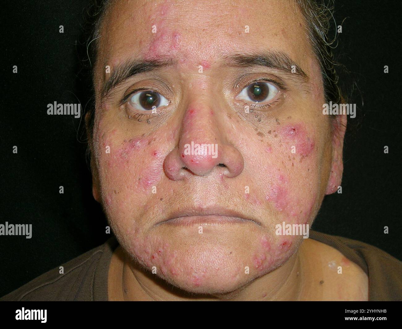 Editorial use only Rosacea on a female patient's face. Rosacea usually ...