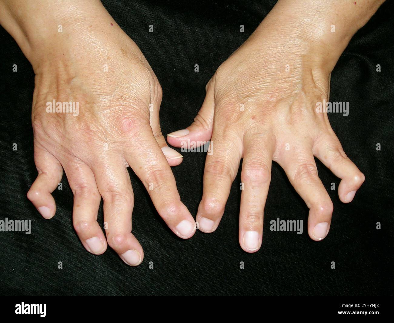 Swan neck deformity of the fingers in rheumatoid arthritis. Rheumatoid ...