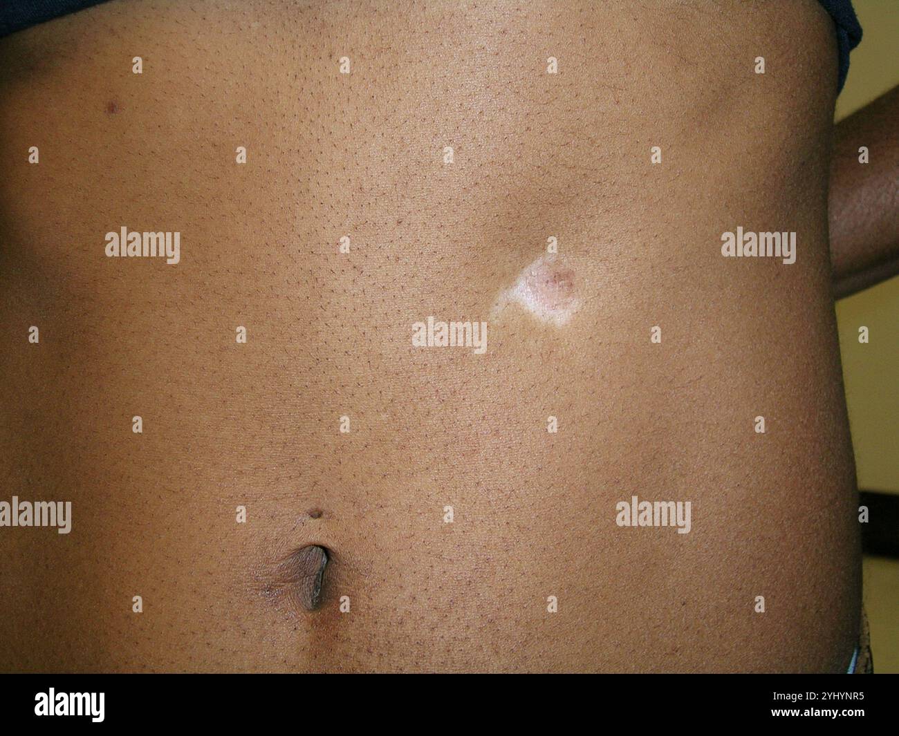 Atrophied and depigmented skin (white) on the abdomen of a patient who ...