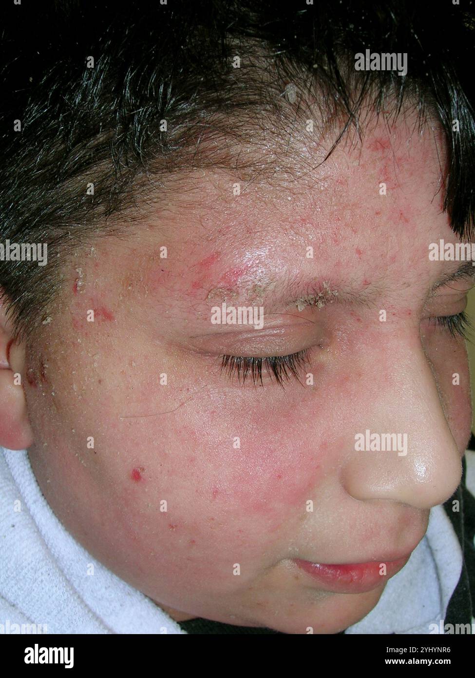 Atopic dermatitis on a patient's face. Atopic dermatitis, also called ...