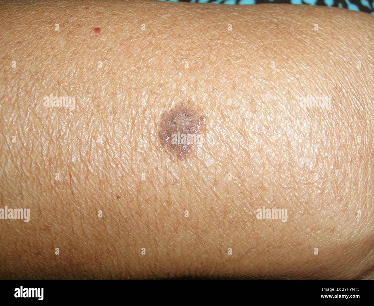 Seborrheic keratosis on a patient's skin. This skin growth, also known ...