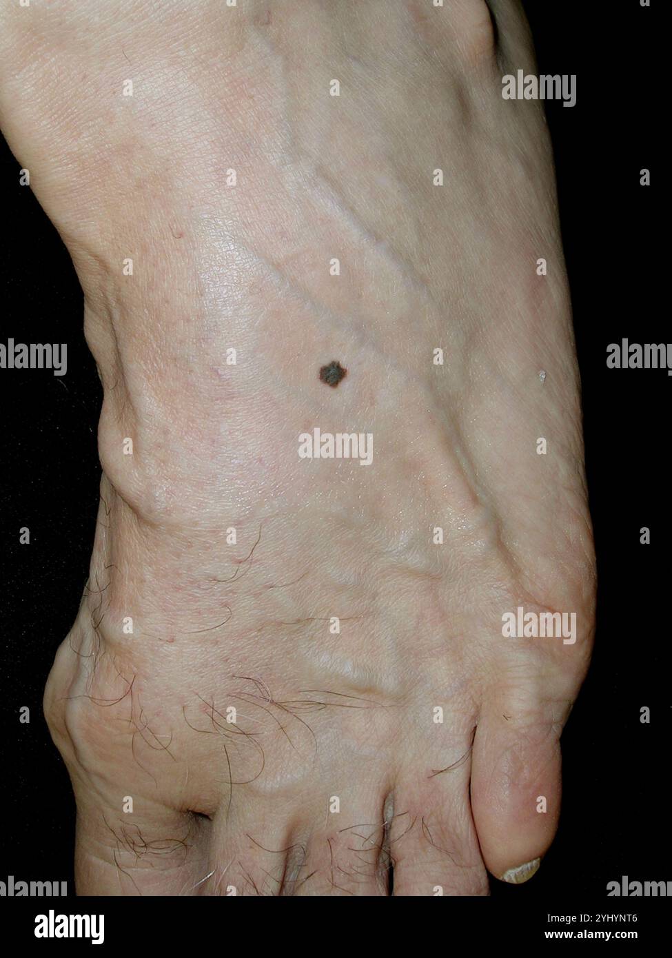 Seborrheic keratosis on a patient's foot. This skin growth, also known ...