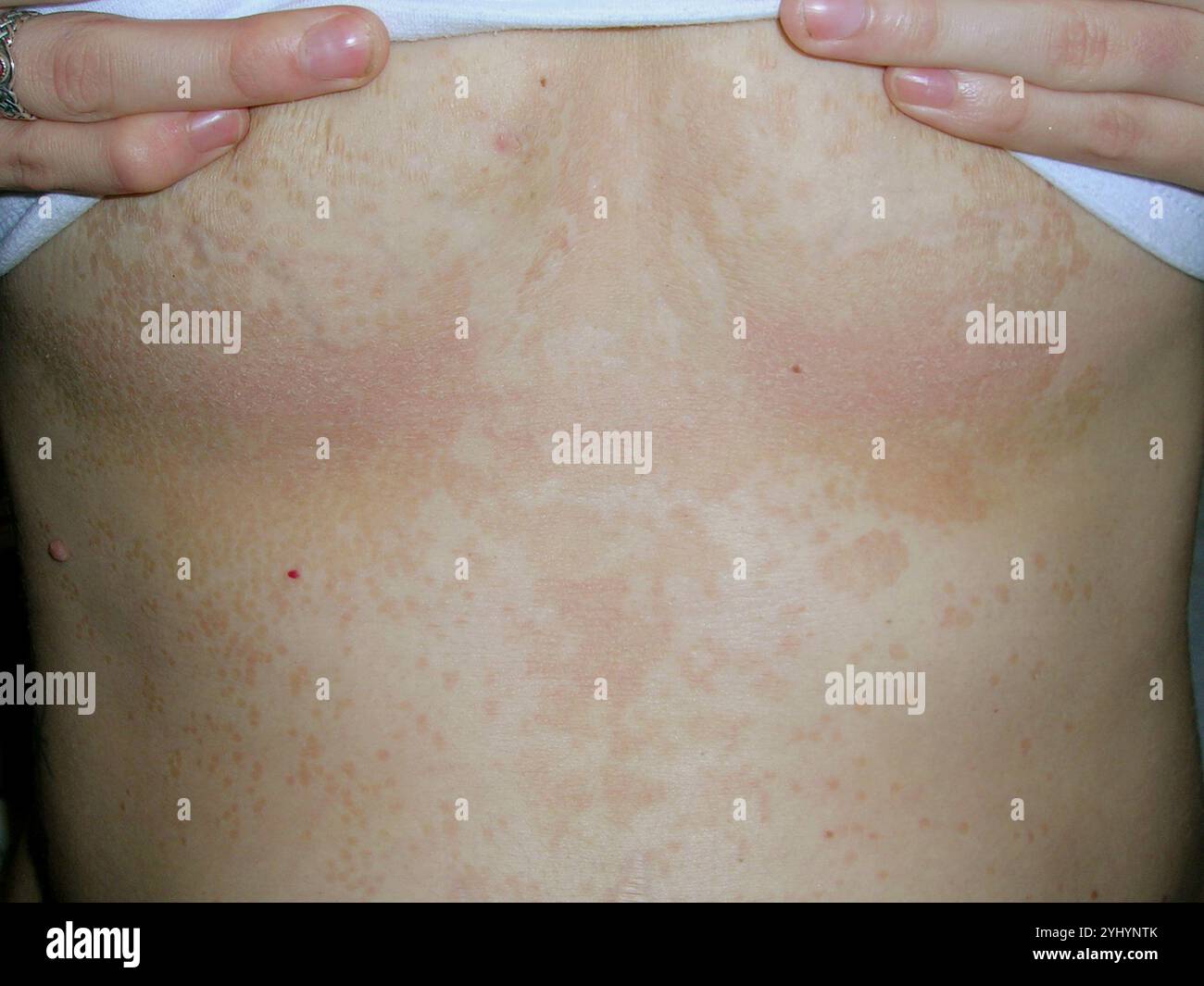 Lesions on the chest of a patient with the fungal infection tinea ...