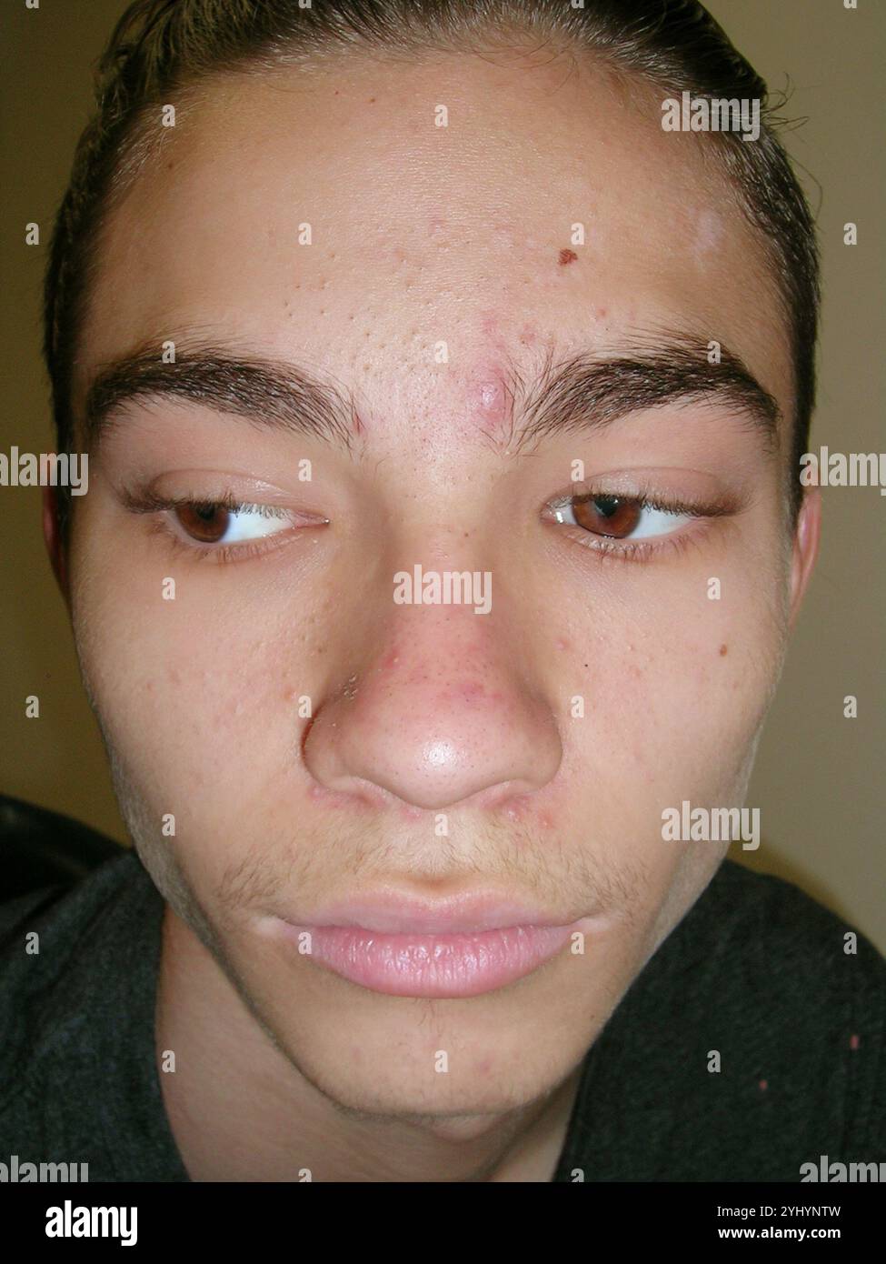 Editorial use only Vitiligo and acne on a 15 year old patient's face ...