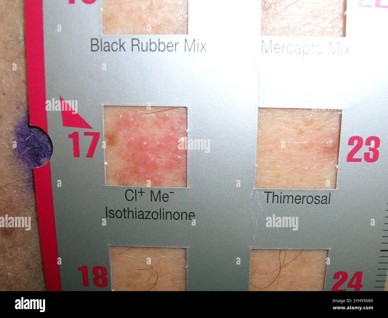 Allergy patch test with inflamed skin showing that the patient is ...