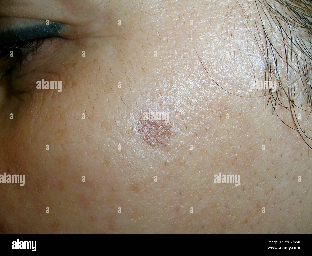 Solar lentigo on a patient's cheek. A solar lentigo is a flat brown ...