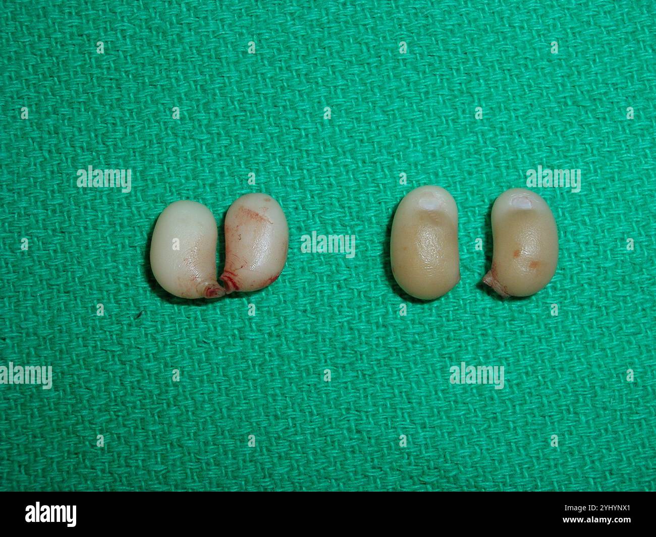 Extra fingers that have been removed from the hands of twin babies ...