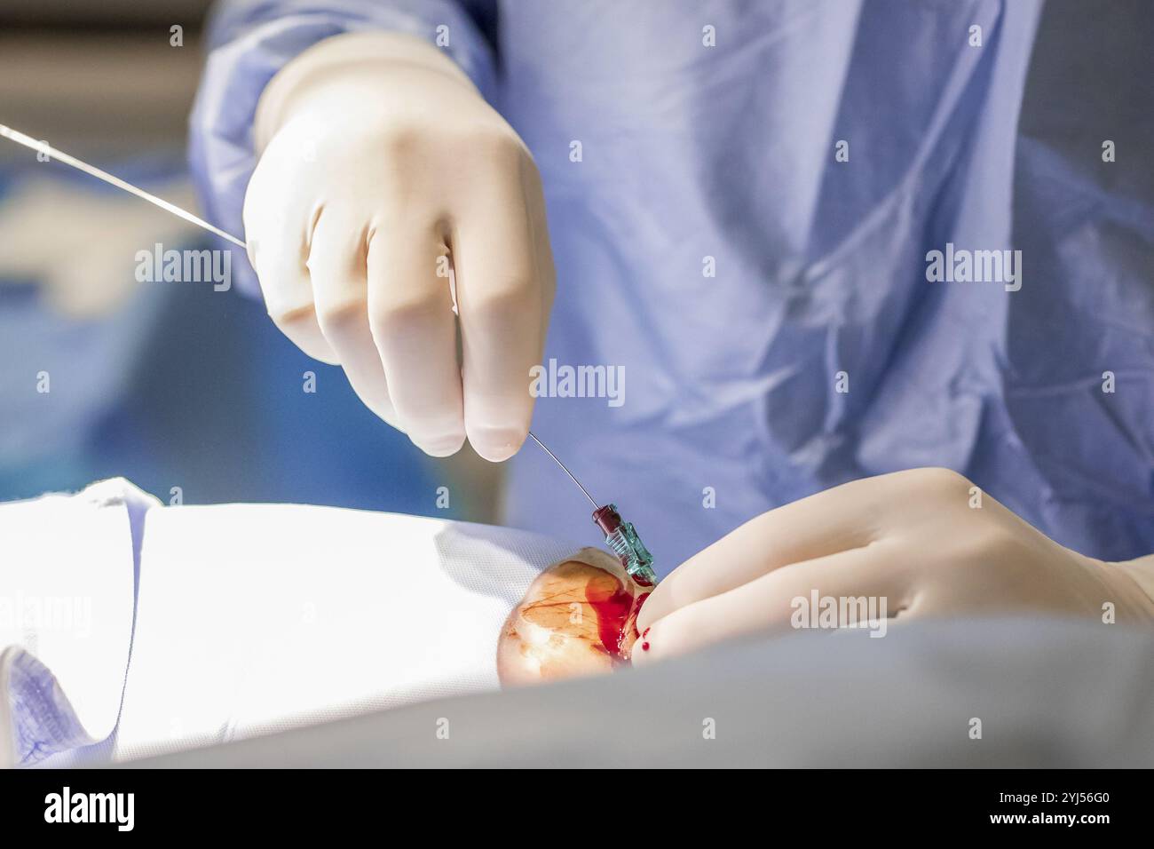 A Surgical Procedure Conducted with Precision Tools and in a Sterile ...