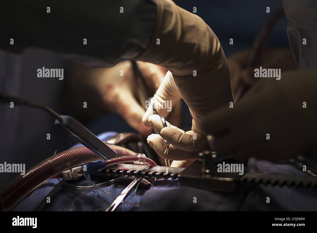 A Surgical Procedure performed under the bright lights of the Operating ...