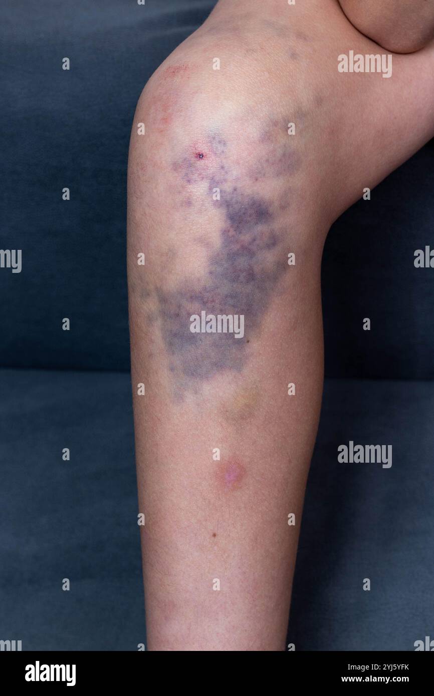 Woman bruise leg domestic violence hi-res stock photography and images ...