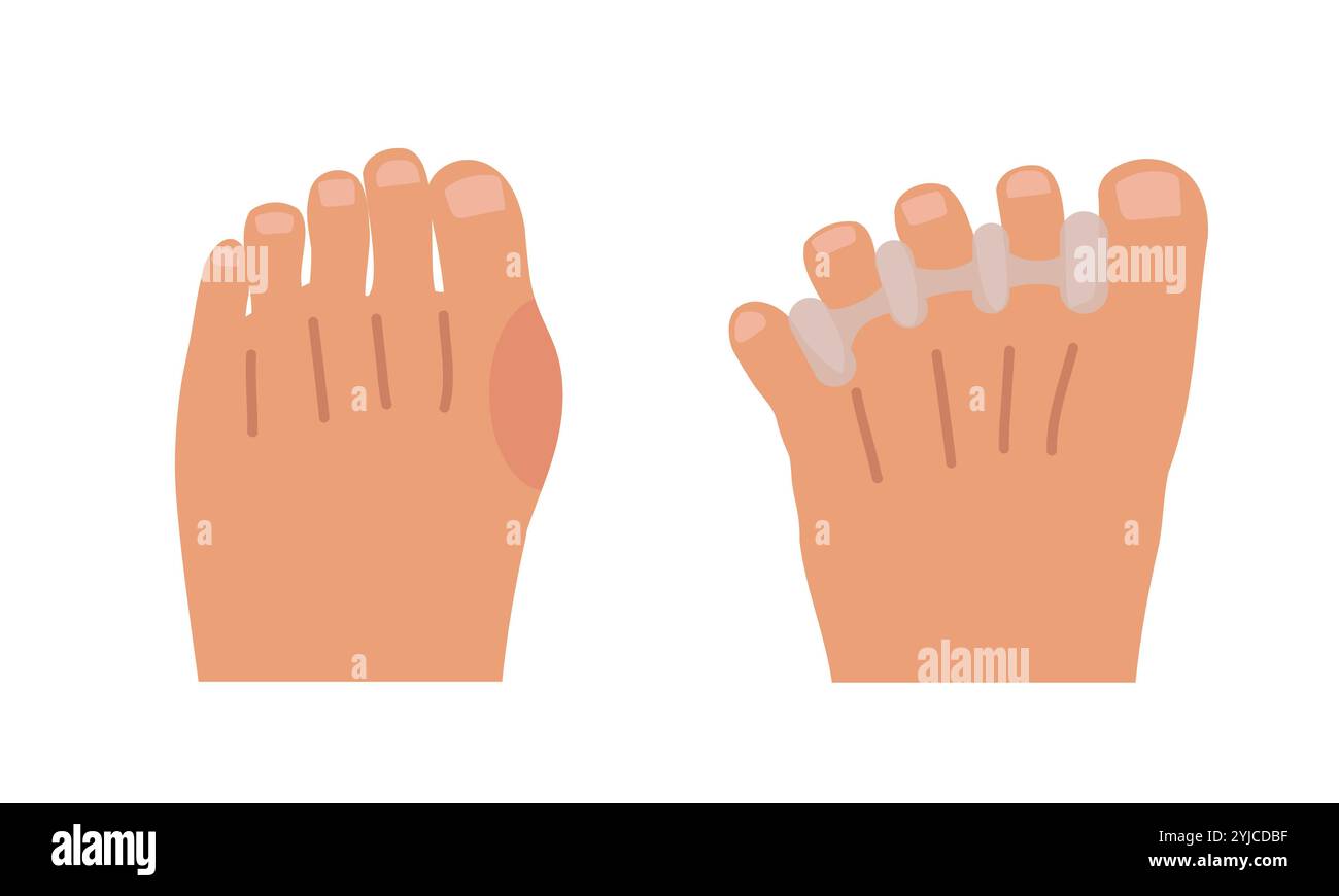 Infographic for feet health. Tight toes before, waring toe spacers ...