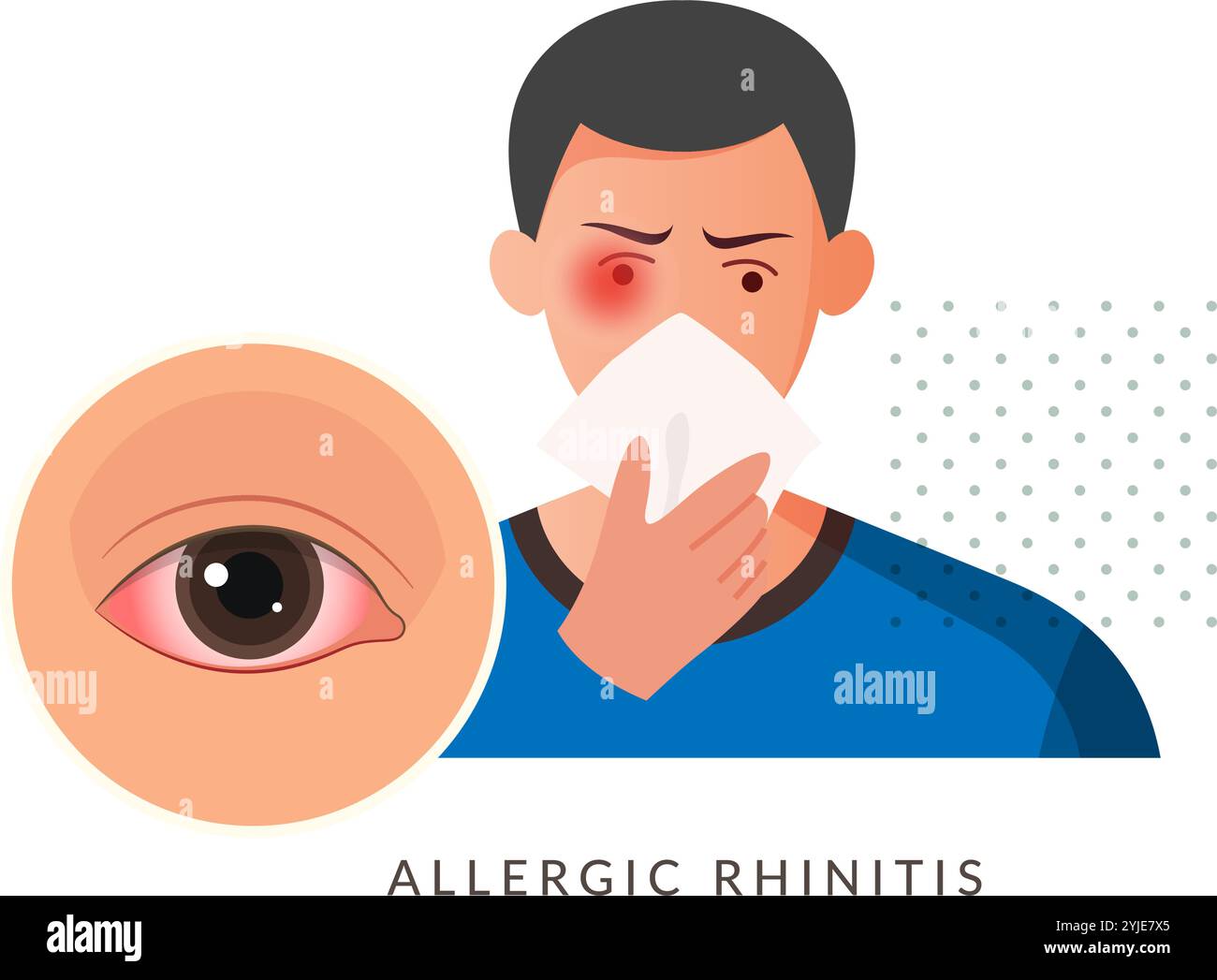 Allergic rhinitis also known as hay fever - Stock Illustration as EPS ...