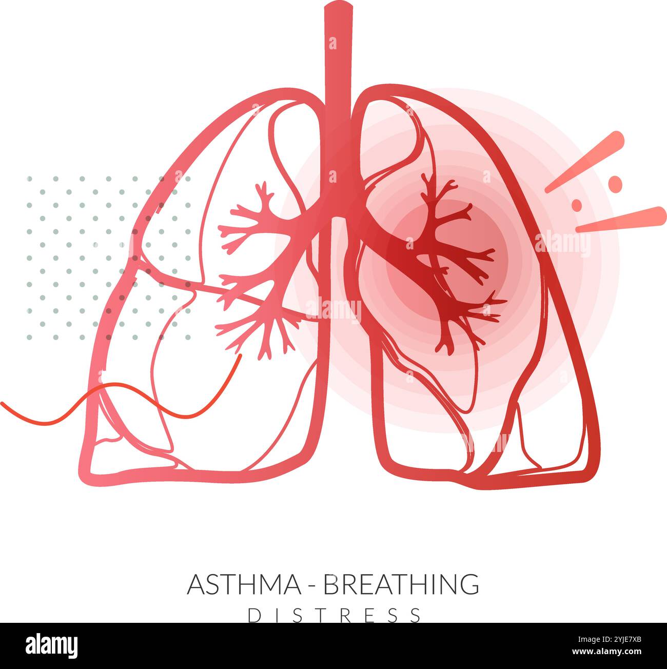 Asthma - Lungs with Breathing Distress - Stock Illustration as EPS 10 ...
