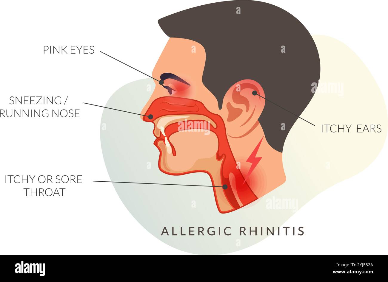Allergic rhinitis Symptoms - Sneezing - Running Nose - Stock ...
