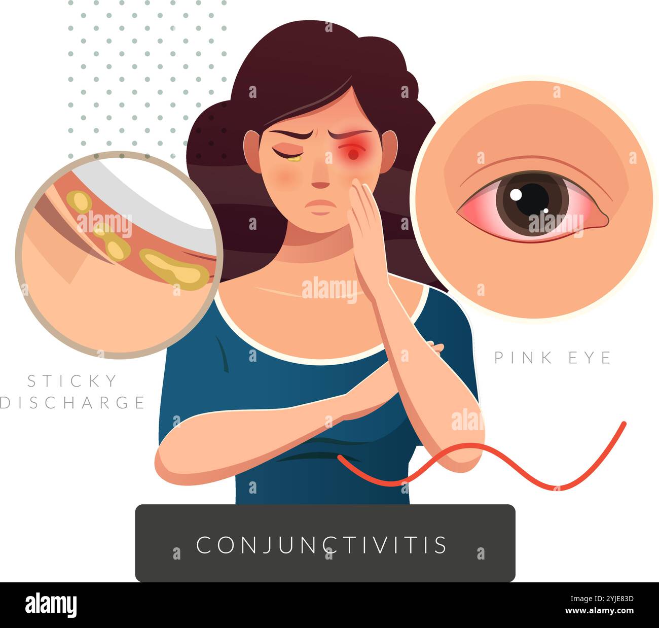 Conjunctivitis - Pink eye and Excessive Sticky Discharge from Human Eye ... Conjunctivitis - Pink eye and Excessive Sticky Discharge from Human Eye ...