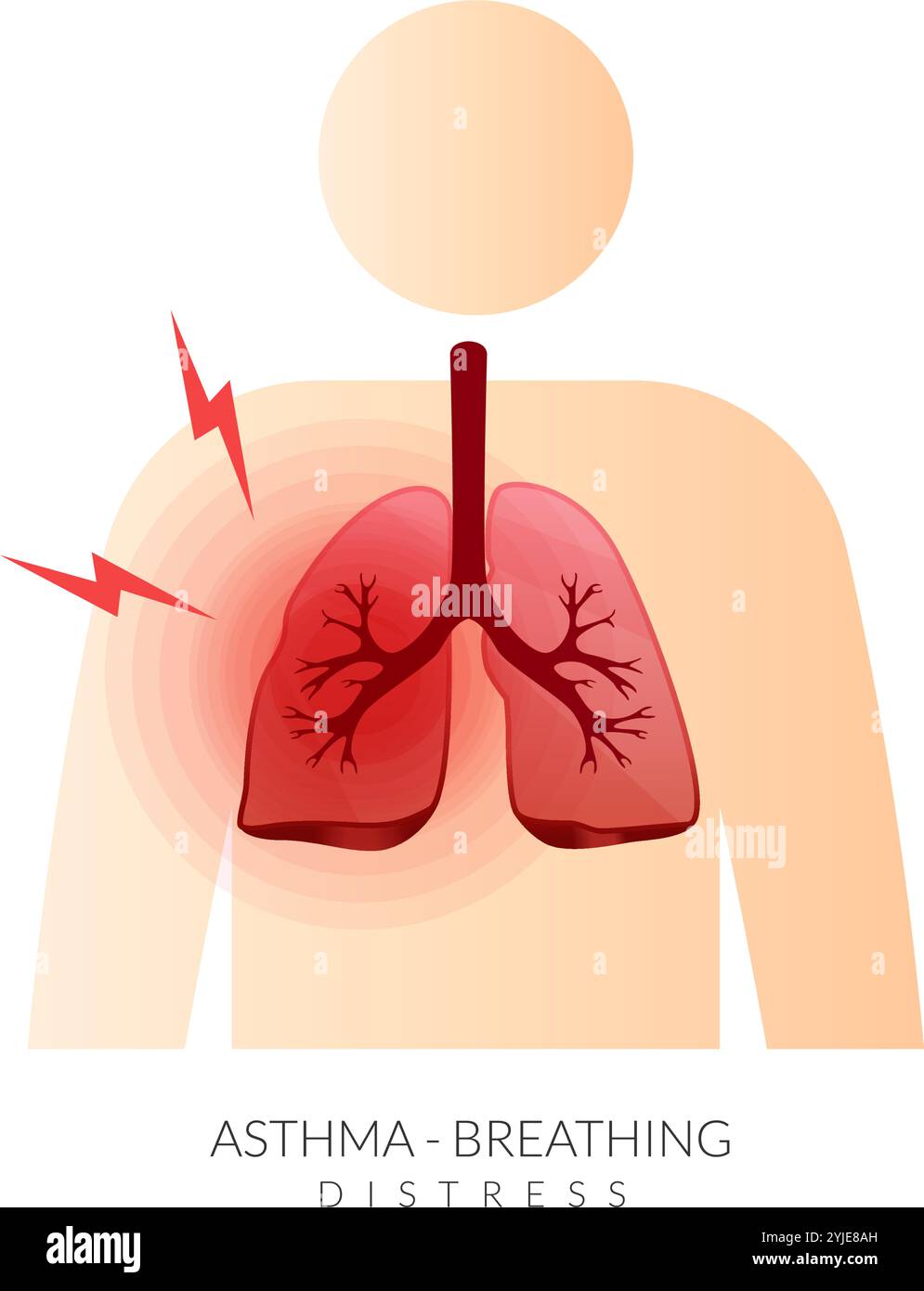 Asthma - Lungs with Breathing Distress - Stock Illustration as EPS 10 ...