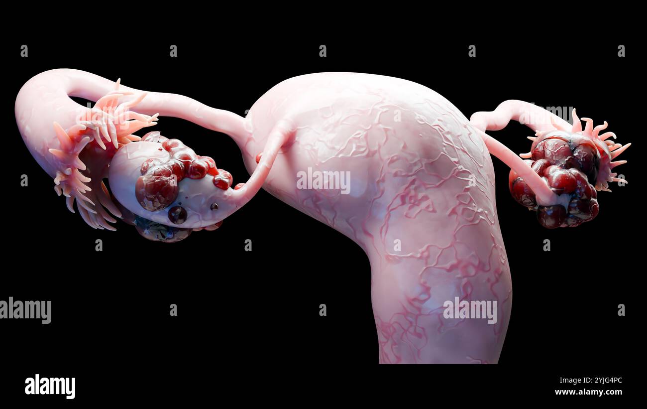 Ovarian malignant tumor, Female uterus anatomy, Reproductive system ...