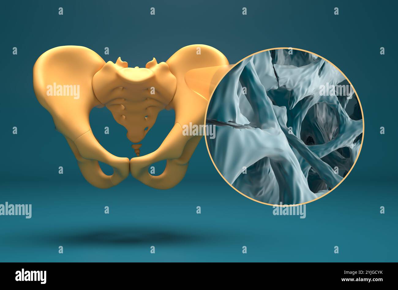 Fracture bone in Osteoporosis - isometric view 3d illustration Stock ...
