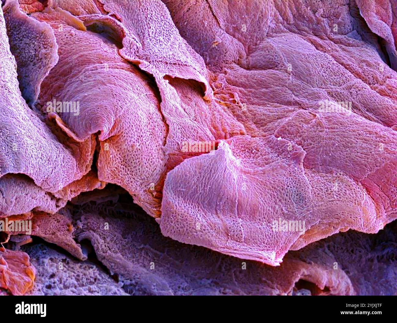 Wound scab. Coloured scanning electron micrograph (SEM) of ...