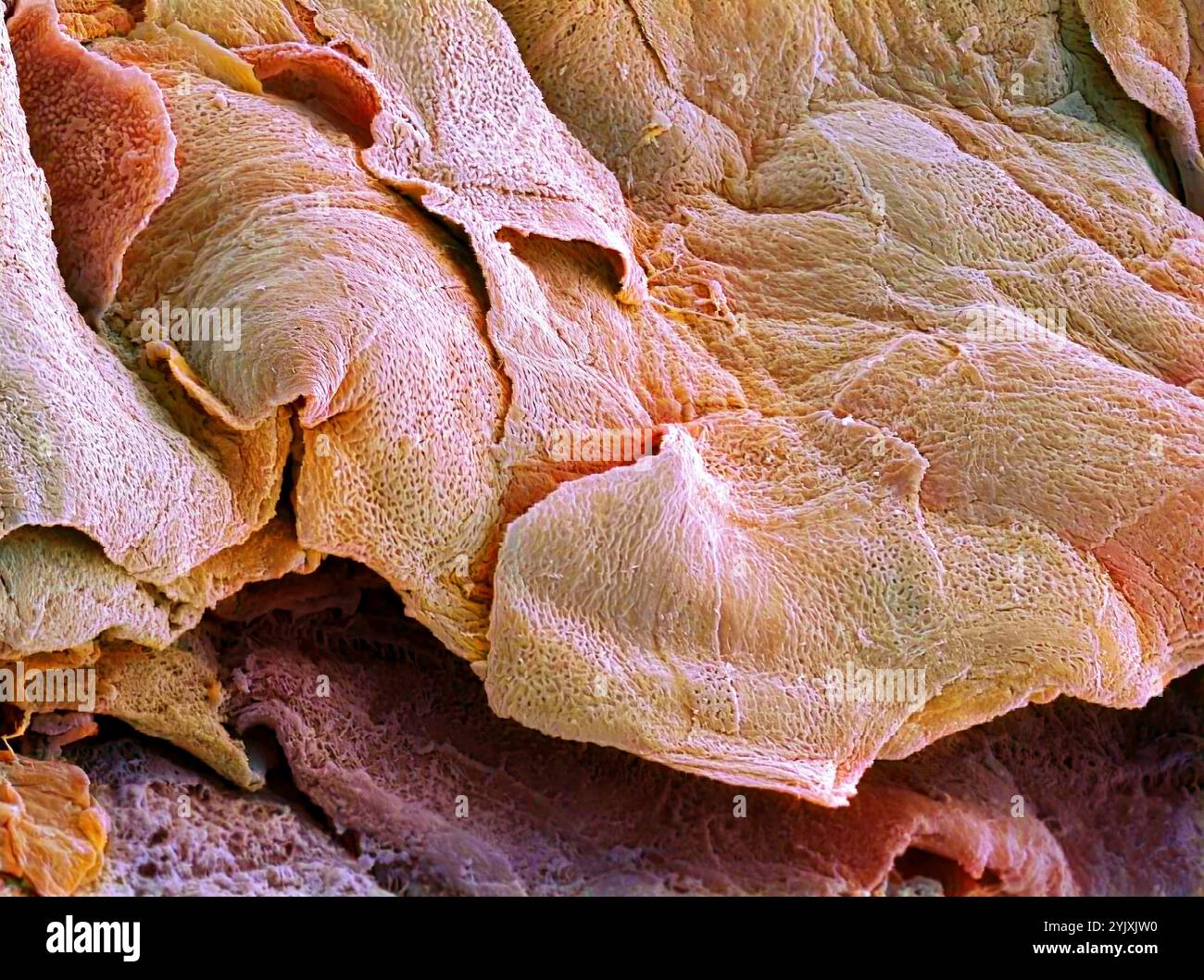 Wound scab. Coloured scanning electron micrograph (SEM) of ...