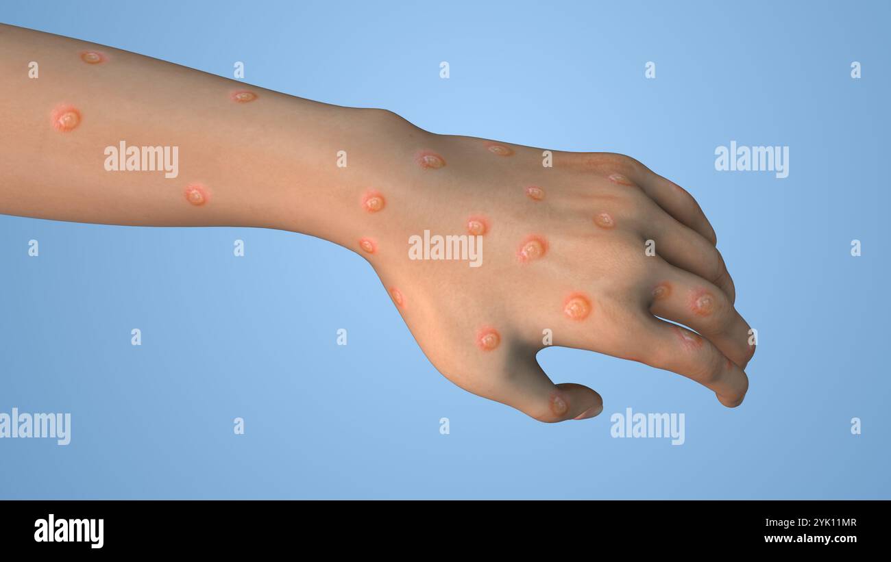 The monkeypox virus in human body Stock Photo - Alamy